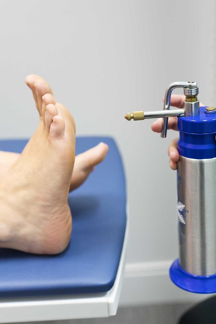 Traitement d’une verrue - Clinique de Soins Infirmiers de Lévis